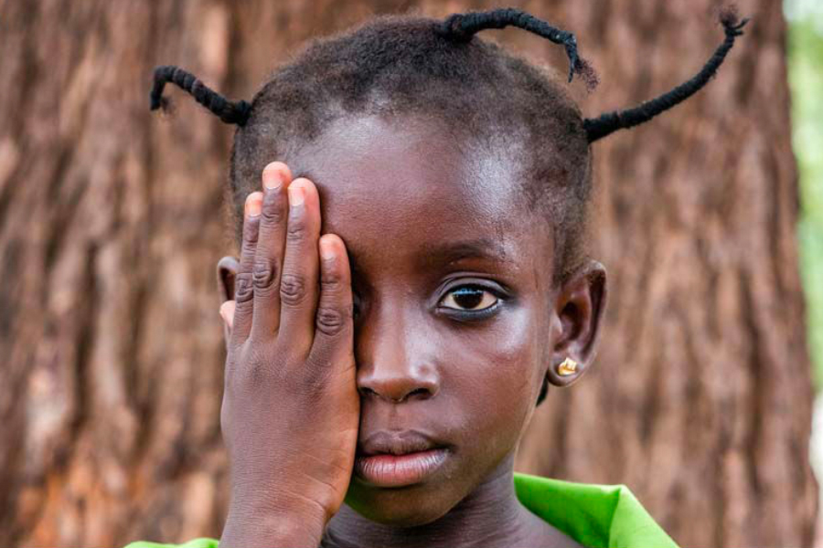 Can Majority of Blindness in Africa Is Preventable?