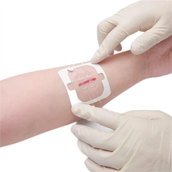 Innovation in Healing: The Impact of New Wound Closure Devices