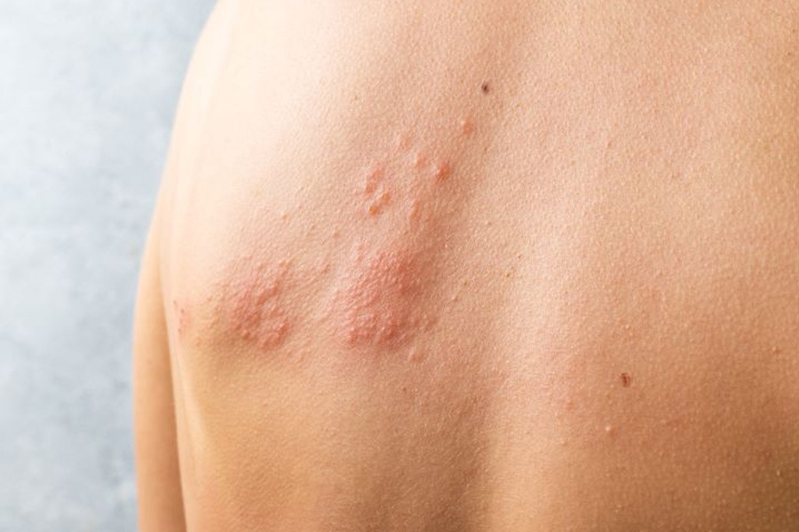 Shingles Vaccine Facts & Side Effects